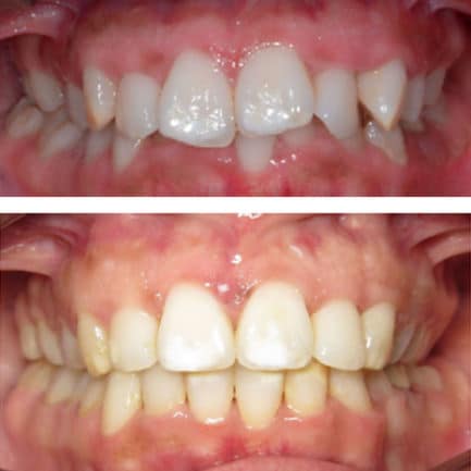 Smile Gallery | Westwood Orthodontics