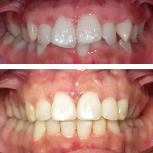 Smile Gallery | Westwood Orthodontics