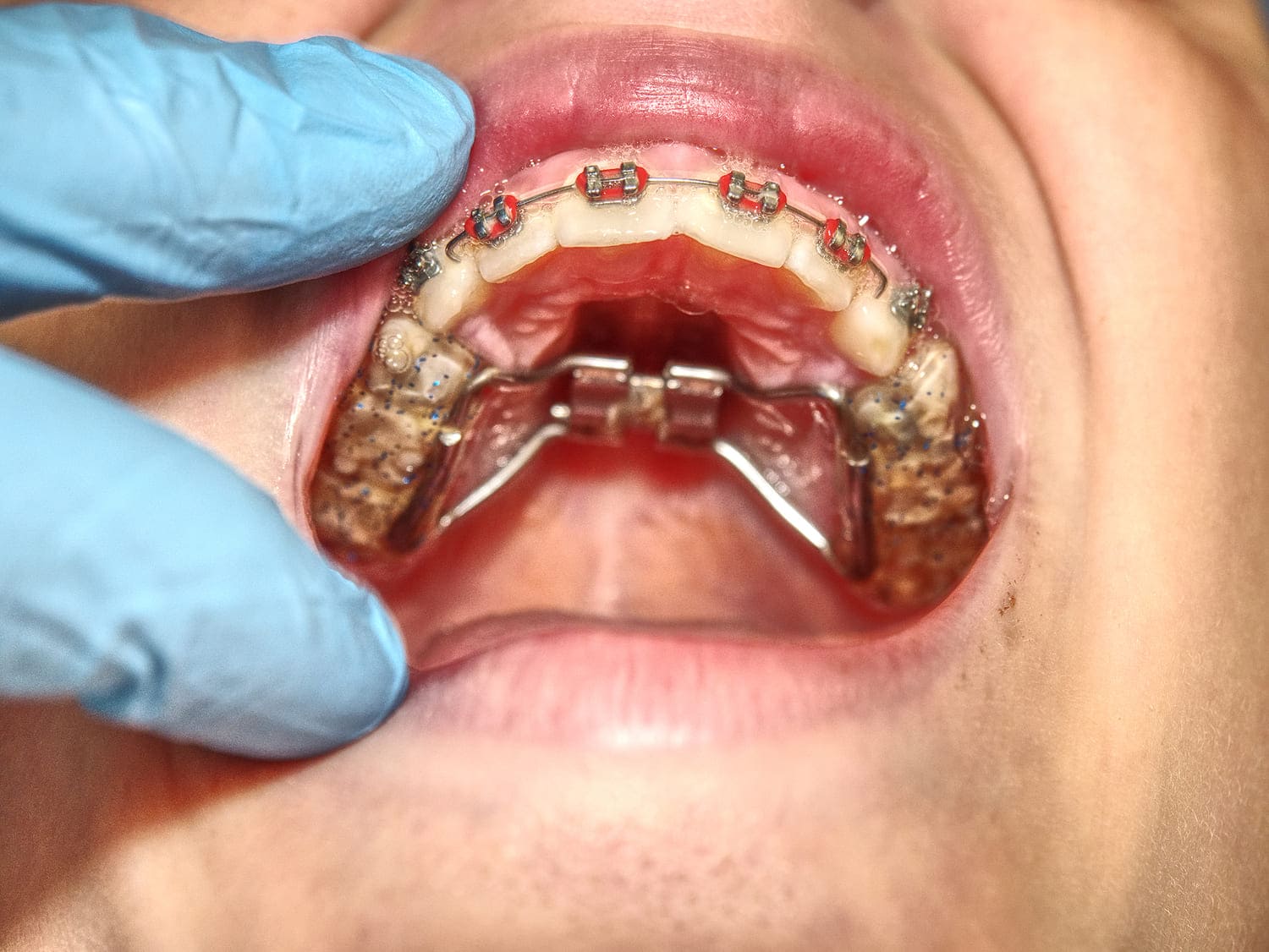 Traditional Expanders In Los Angeles | Westwood Orthodontics